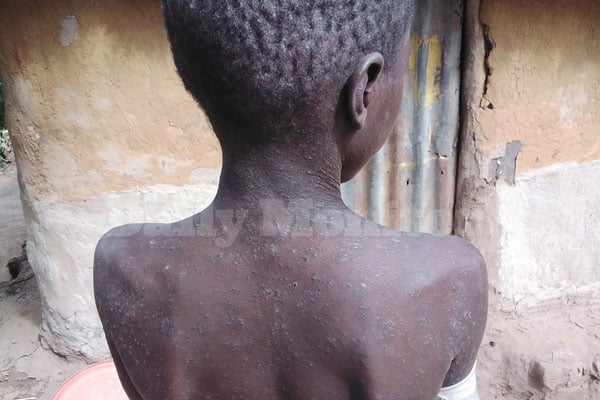 Strange scabies-like disease hits Tororo District - Daily Monitor