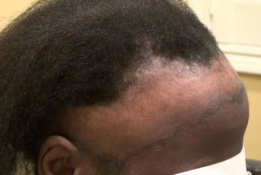 You can re-grow the hair around your hairline | Monitor