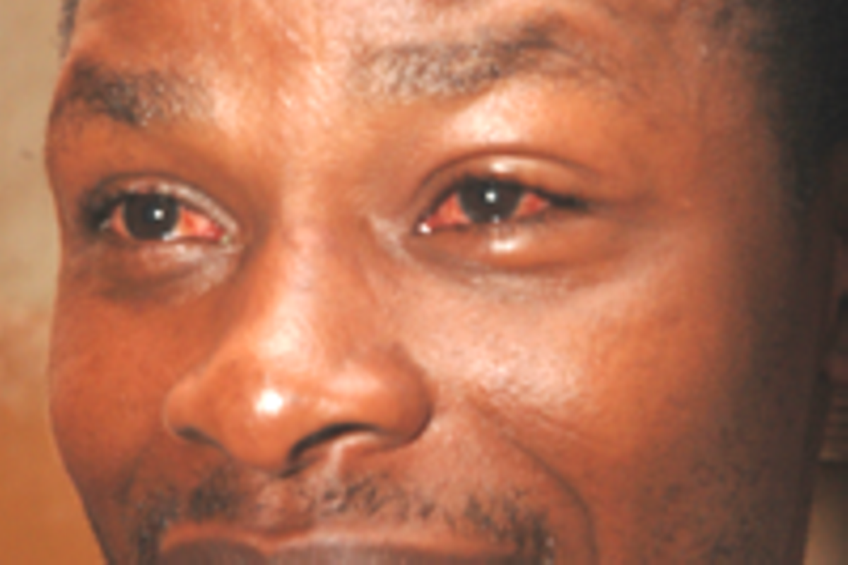 Why is red eye disease on the rise in Uganda? | Monitor